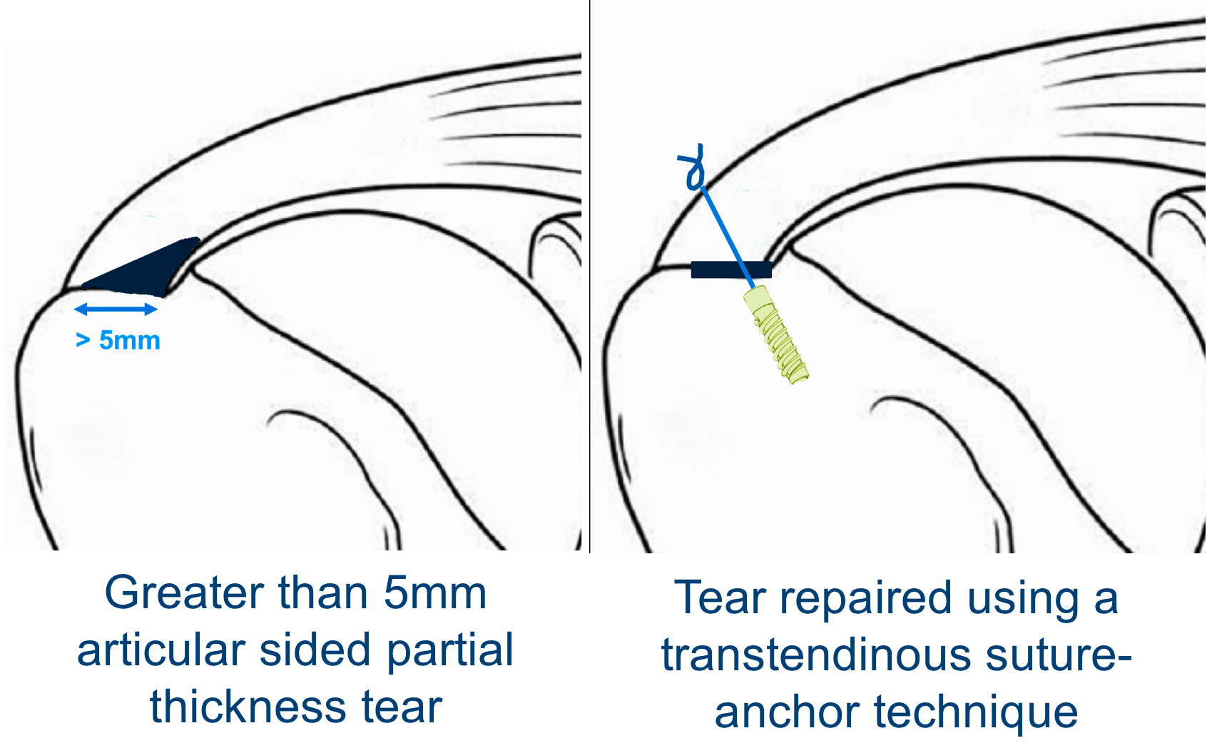 The Rotator Cuff – hannanmullet