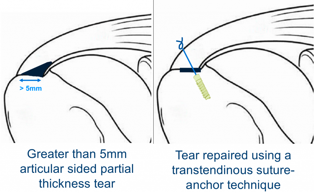The Rotator Cuff – Hannan Mullet